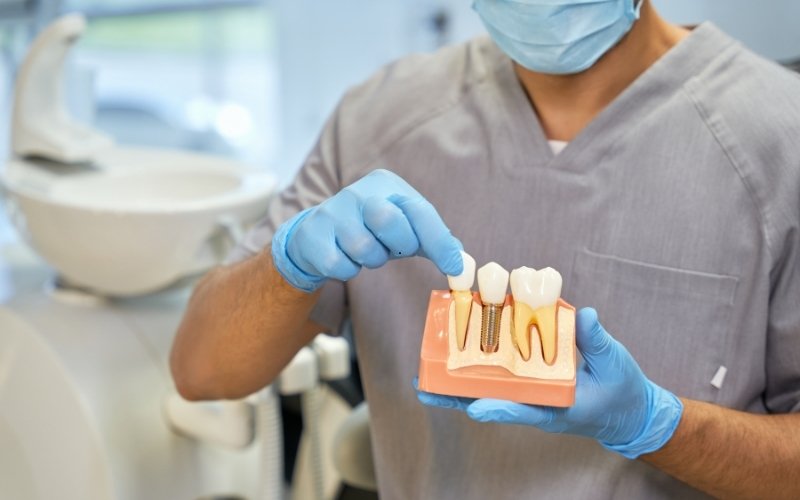New Techniques for Faster Dental Implants Revealed