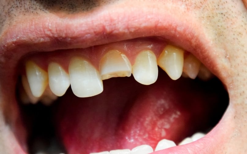 Knocked-Out Tooth Emergency Guide: Step-by-Step Care