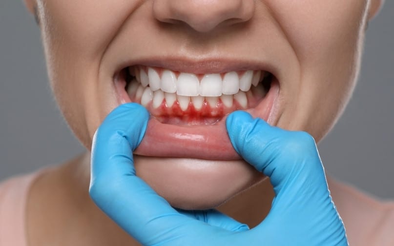 Why Does Blood Come Out Of The Teeth Gum