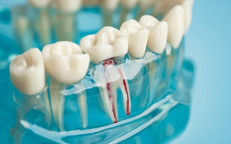 How to Ease Throbbing Pain After a Root Canal?